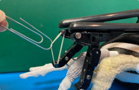 Digit Widget Surgery: A Key Step to Restoring Finger Mobility