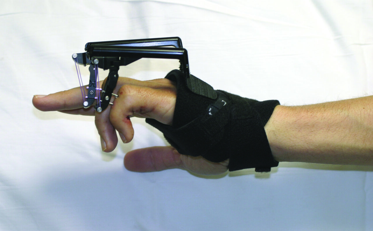 Reverse severe PIP flexion contractures with Digit Widget