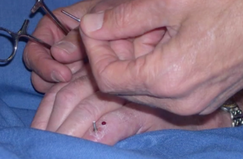 Removal of Digit Widget: What to Expect & Next Steps in Treatment