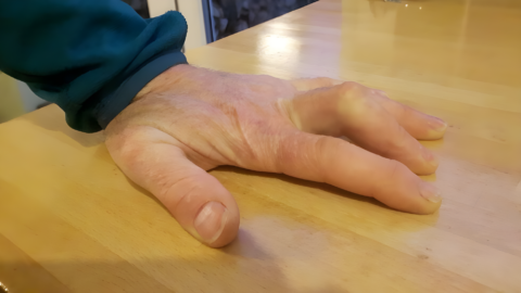 Understanding PIP Flexion Contractures: Causes, Treatment, Digit Widget ...