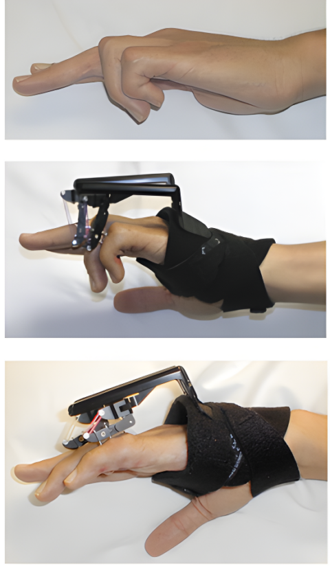 Digit Widget: Proven Solution for Severe PIP Flexion Contractures