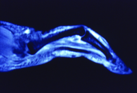 Understanding PIP Flexion Contractures: Causes, Treatment, Digit Widget ...