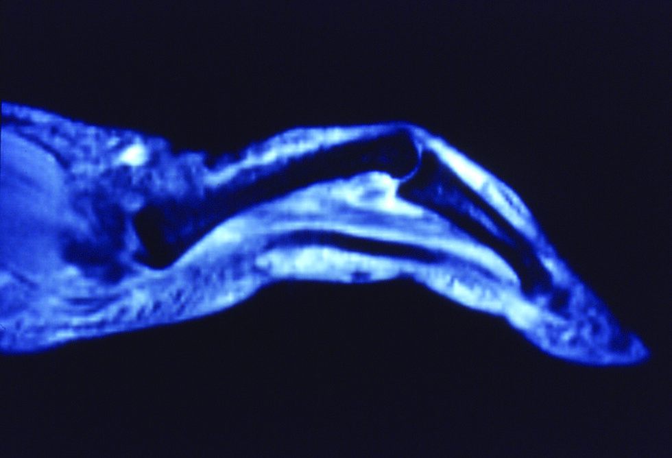 Understanding PIP Flexion Contractures: Causes, Treatment, Digit Widget ...