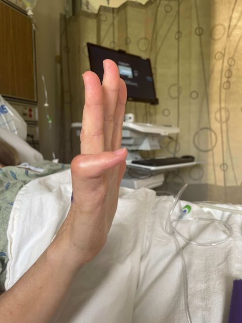 Proximal Phalanx Fracture Finger Surgery - Digit Widget